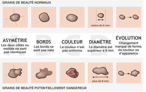Grain de beauté: Dr Bouhassira spécialiste à Cannes Antibes en ... Grain de beauté: Dr Bouhassira spécialiste à Cannes Antibes en ...